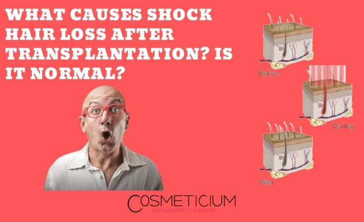 What Causes Shock Hair Loss After Transplantation? - Cosmeticium
