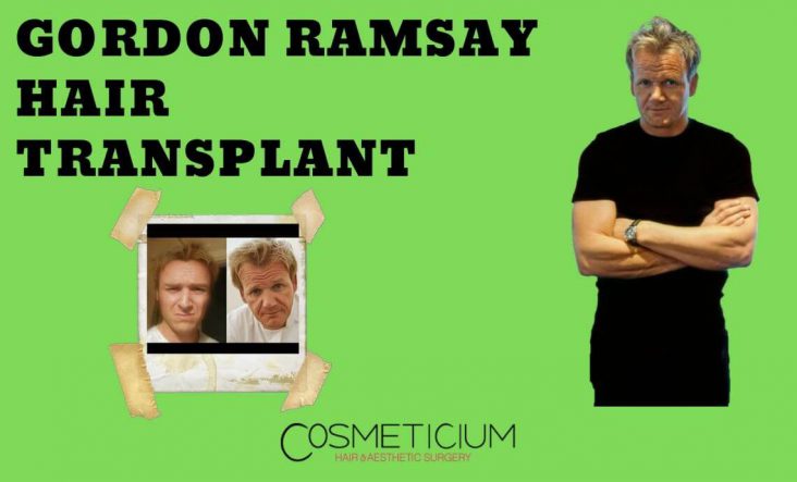 gordon ramsay hair transplant Archives - Cosmeticium