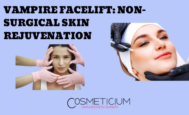 Vampire Facelift: Non-Surgical Skin Rejuvenation - Cosmeticium