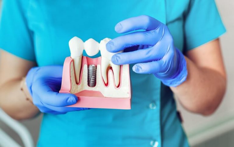 7 Signs of Dental Implant Operation Failure - Cosmeticium