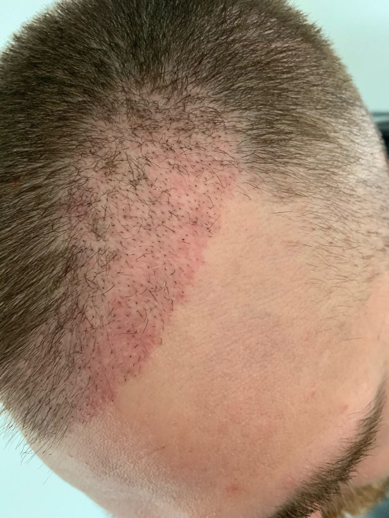 How To Hide Redness After Hair Transplant - Cosmeticium