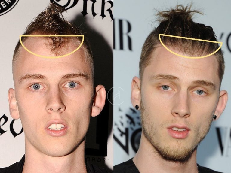 Machine Gun Kelly's Hair Transplant - Cosmeticium