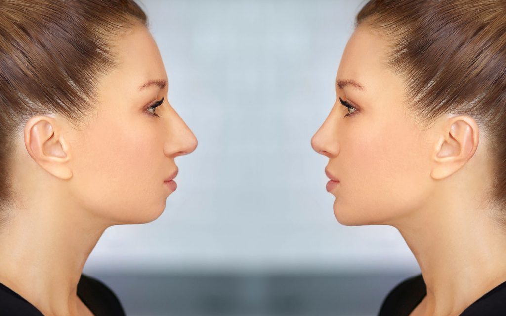 Can A Chin Implant Correct A Retruded Chin?