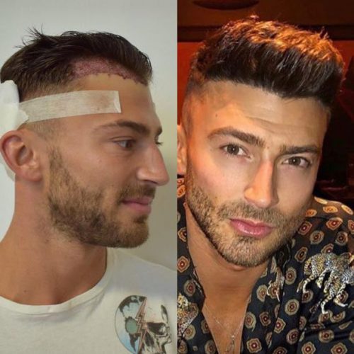 Jake Quickenden's Hair Transplant Journey