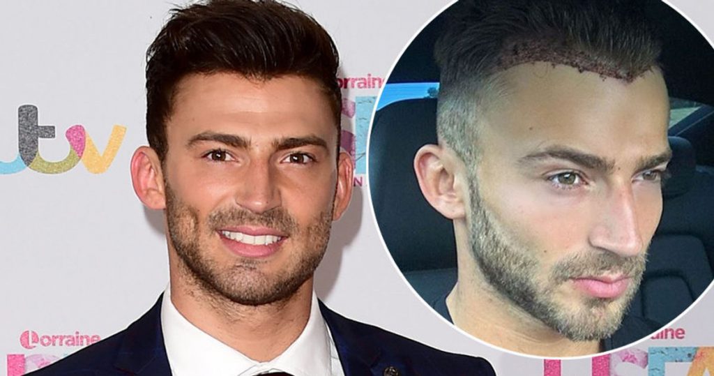Jake Quickenden's Hair Transplant Journey