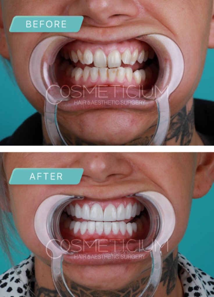 Dental Implants Turkey - All In Inclusive Package - Cosmeticium